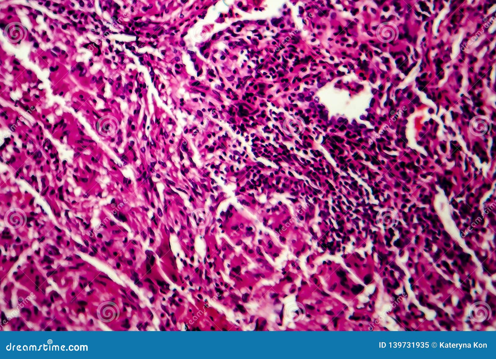 Miliary Tuberculosis, Light Micrograph Stock Image - Image of ...