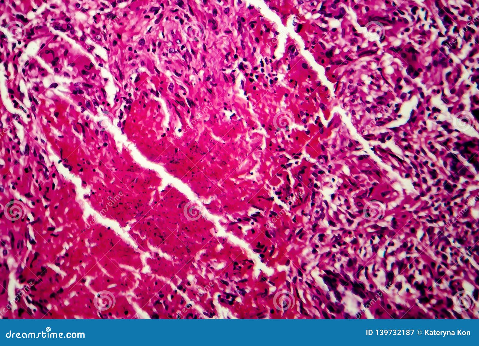 Miliary Tuberculosis, Light Micrograph Royalty-Free Stock Photography ...