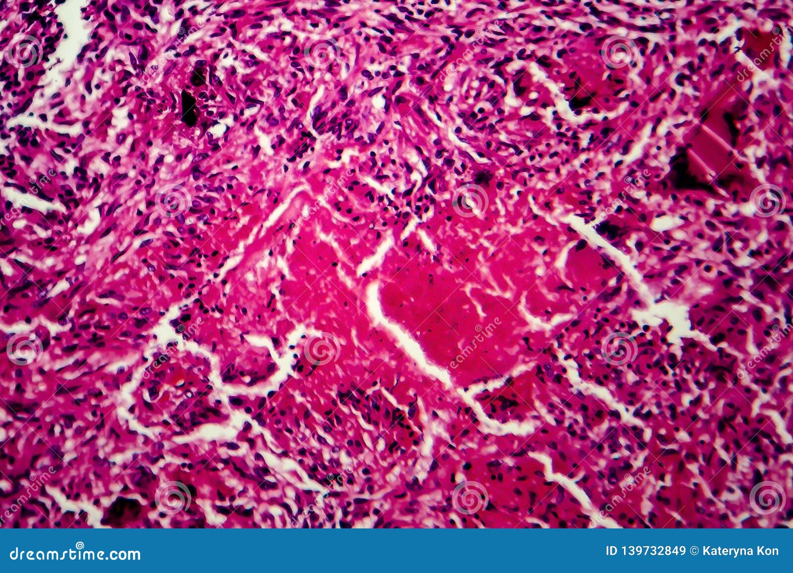 Miliary Tuberculosis, Light Micrograph Stock Image - Image of infection ...