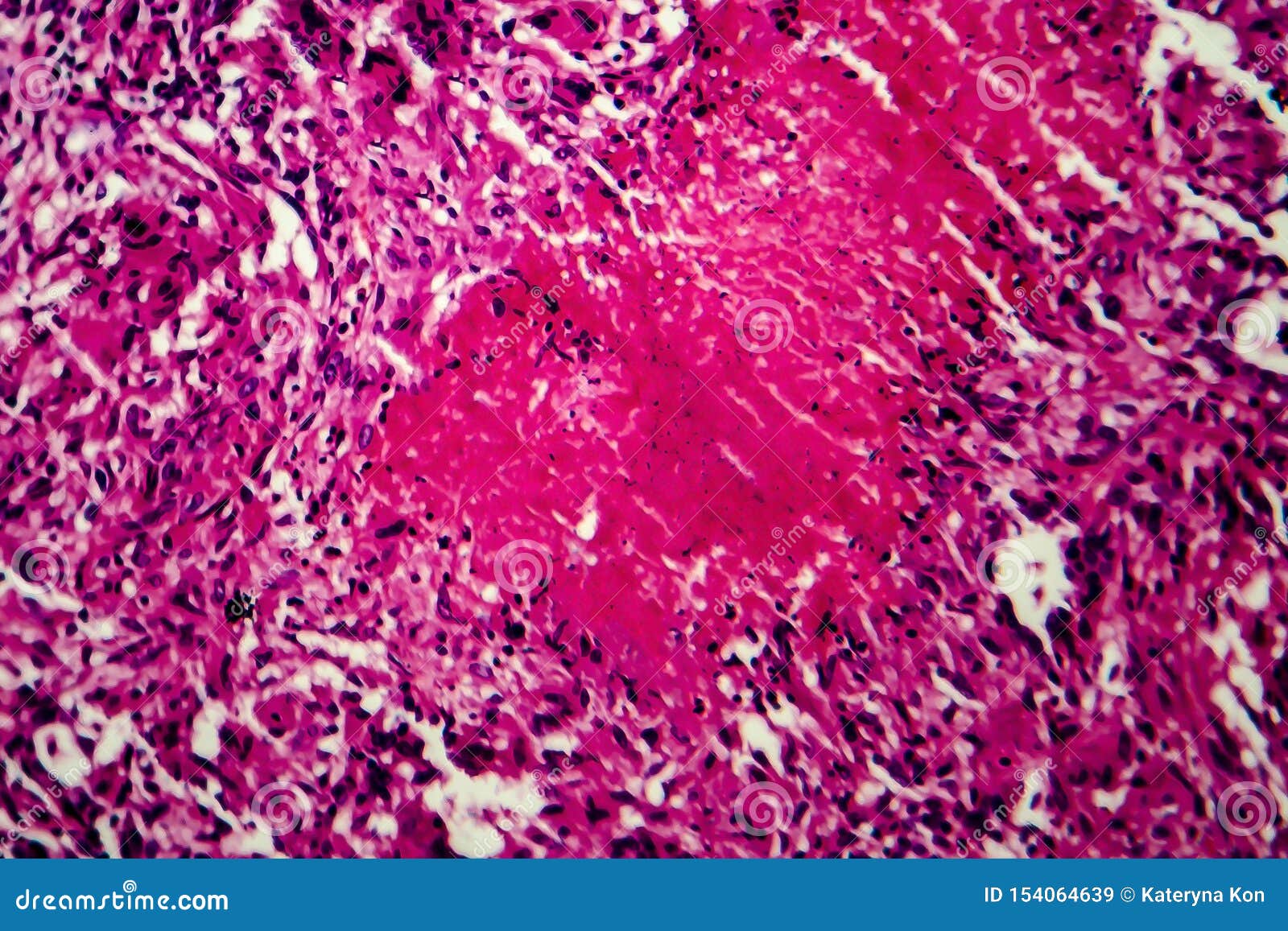 Miliary Tuberculosis, Light Micrograph Stock Image - Image of microbe ...