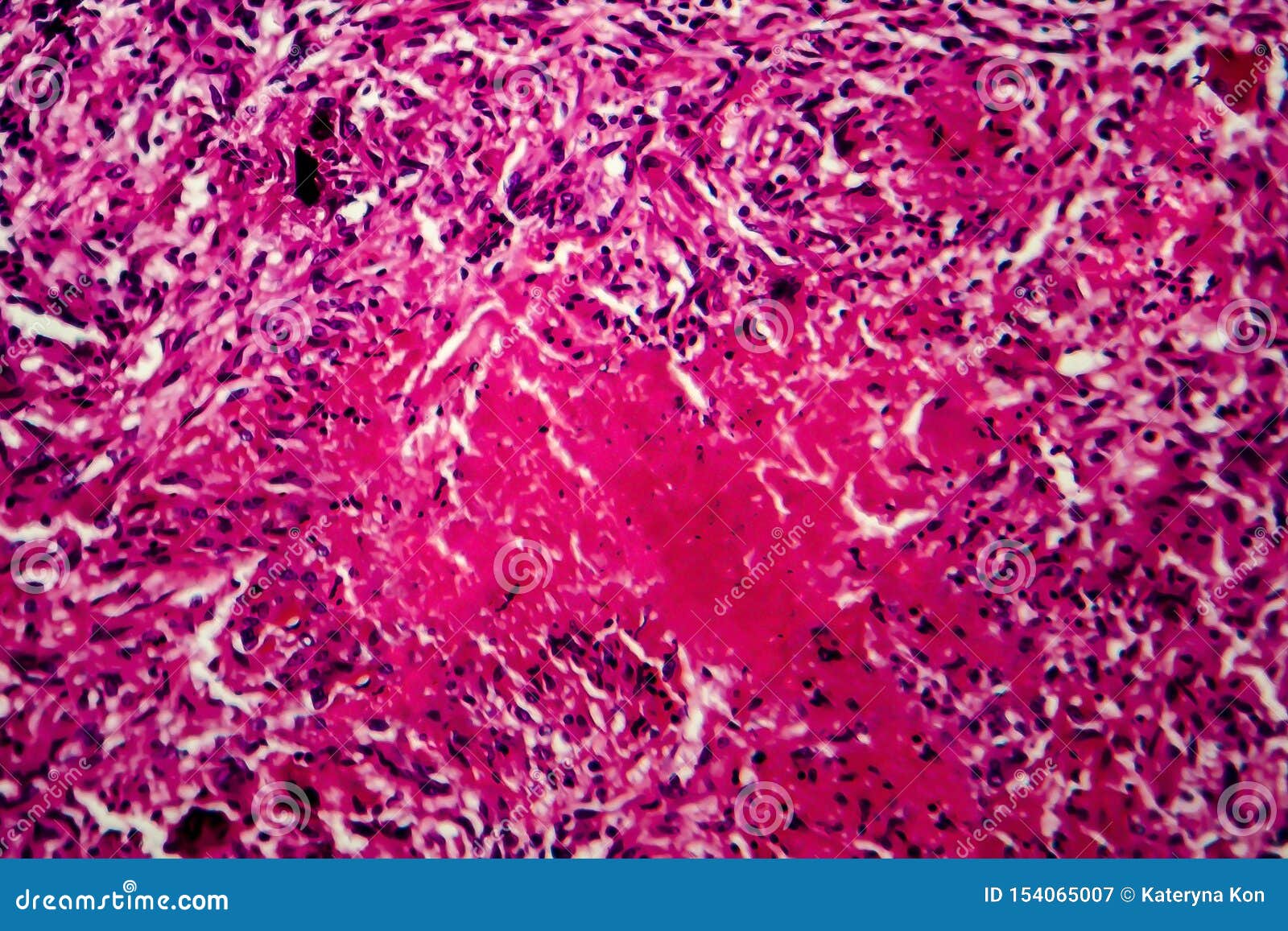 Miliary Tuberculosis, Light Micrograph Stock Image - Image of medicine ...
