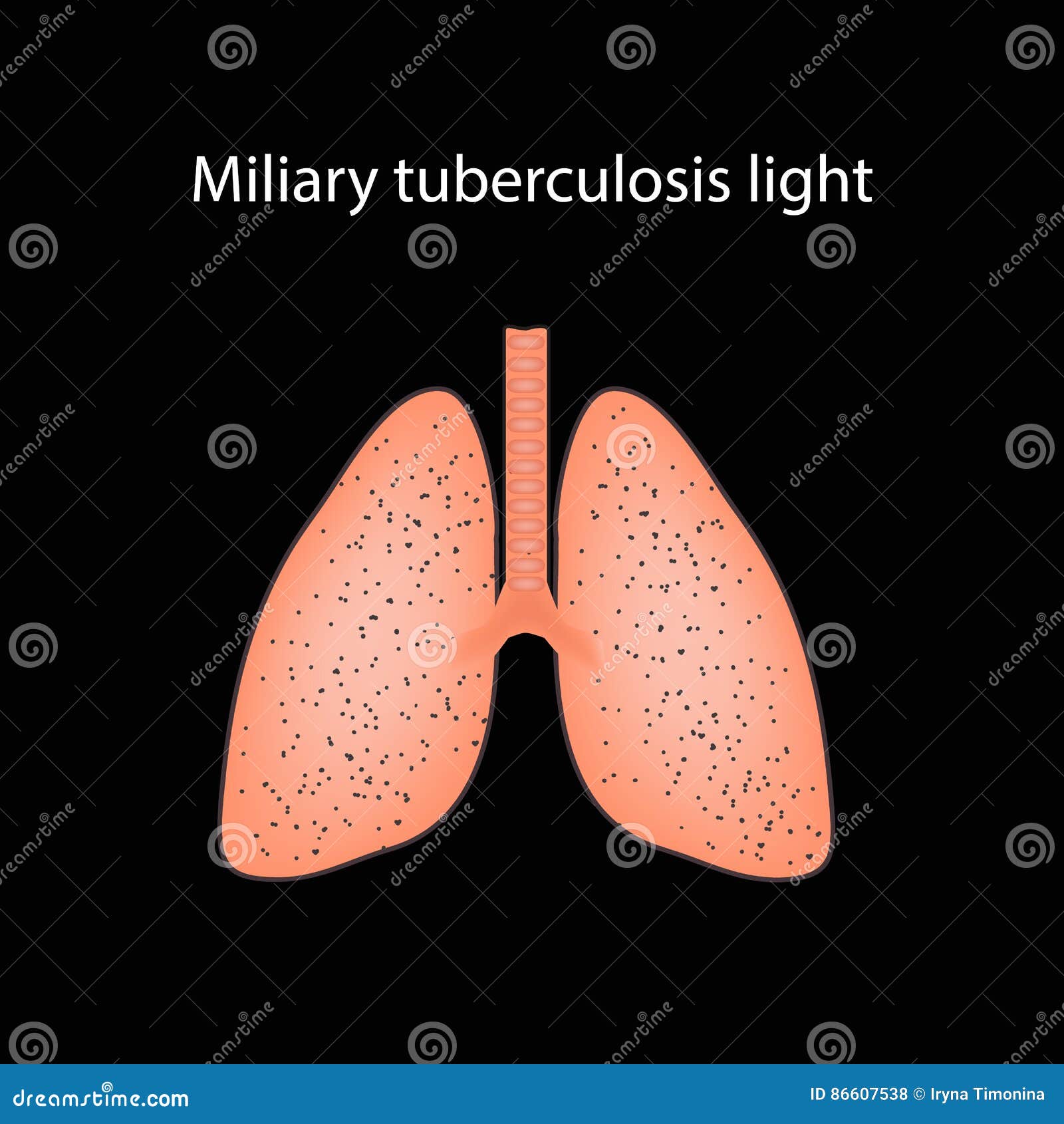 Tuberculosis (TB) Infographics Vector Illustration | CartoonDealer.com ...
