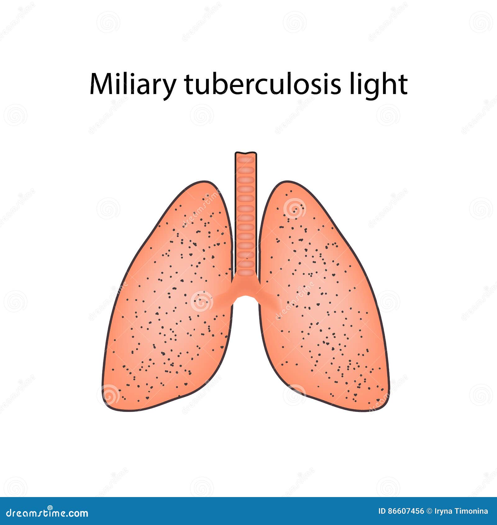 Miliary Tuberculosis. Vector Illustration on Isolated Background Stock ...