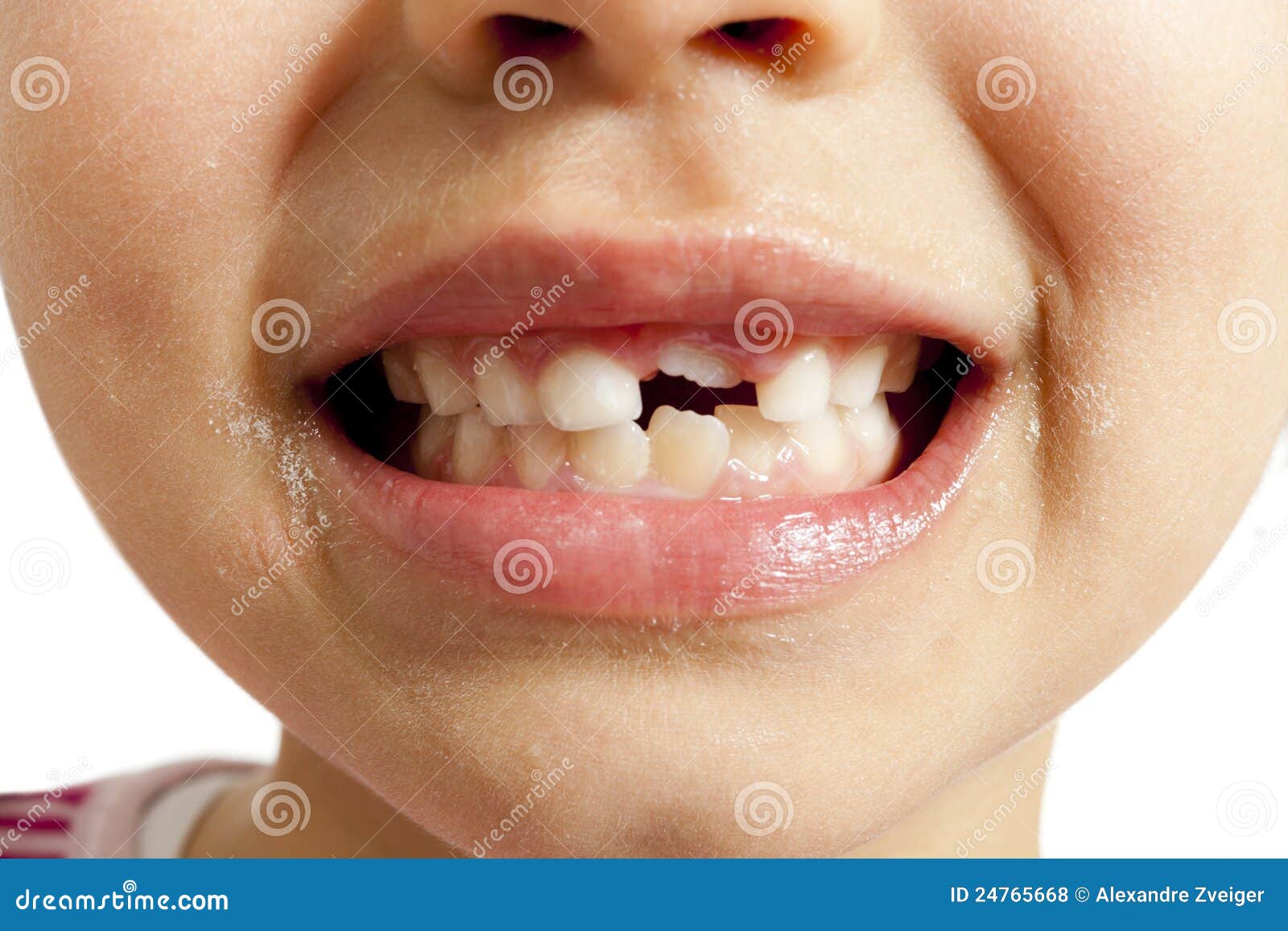 Milk teeth stock photo. Image of skin, growth, young - 24765668
