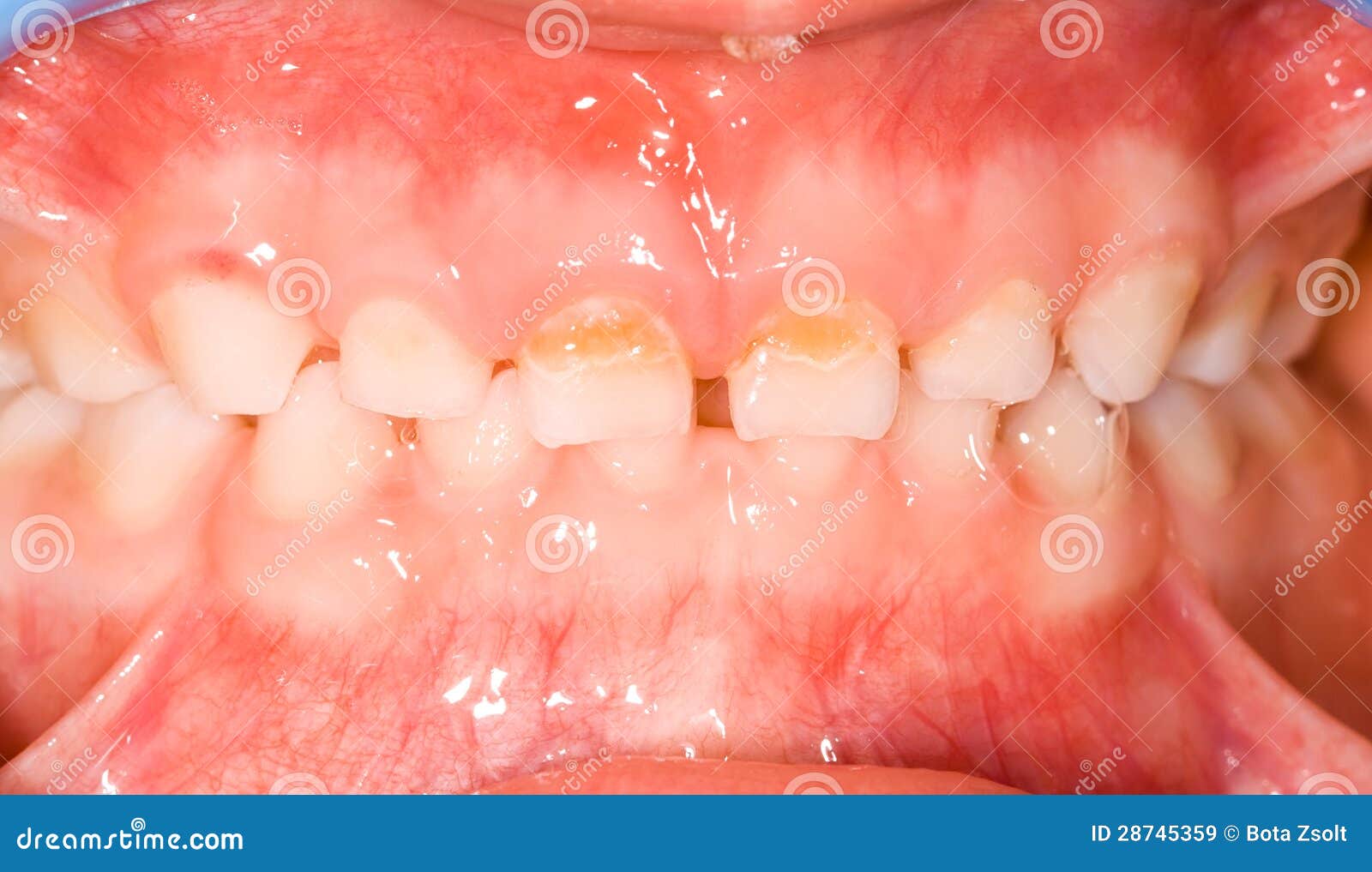 Milk teeth stock image. Image of mouth, teeth, examine - 28745359