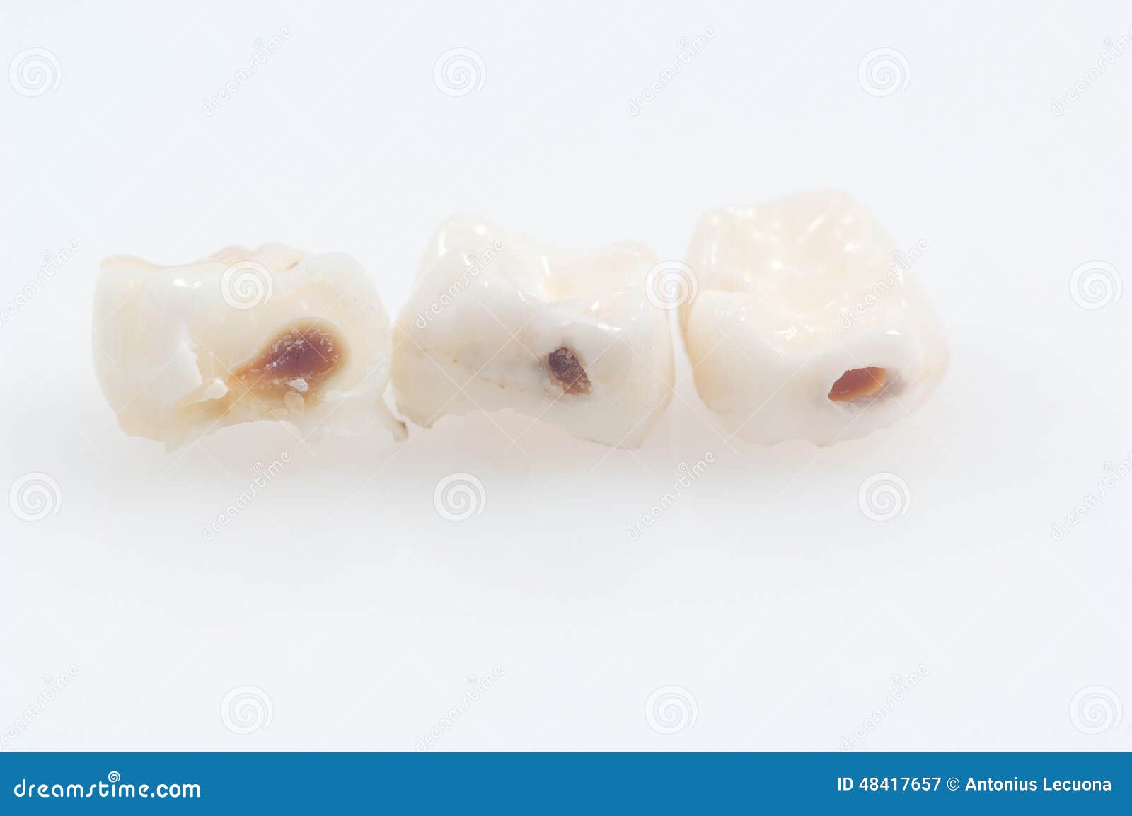 Milk teeth with decay stock image. Image of child, collection - 48417657