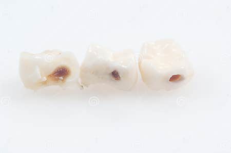 Milk teeth with decay stock image. Image of child, collection - 48417657