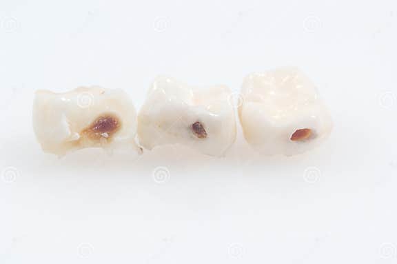 Milk teeth with decay stock image. Image of child, collection - 48417657