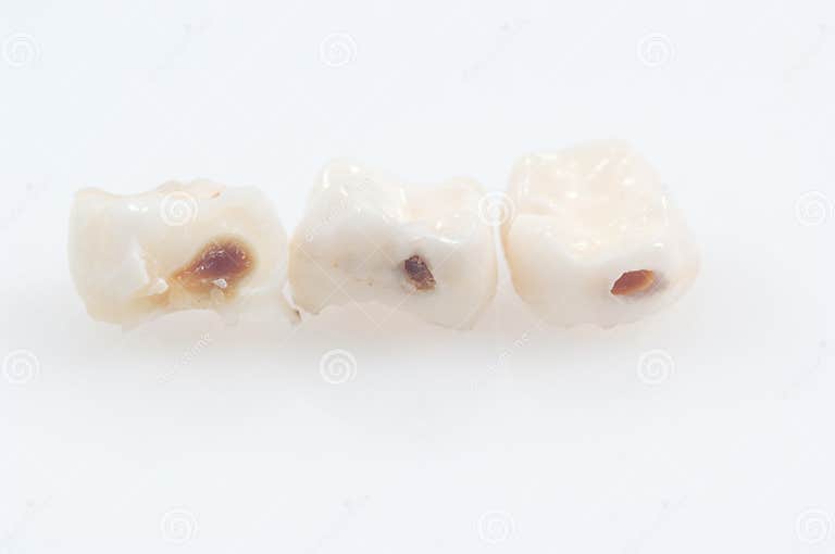 Milk teeth with decay stock image. Image of child, collection - 48417657