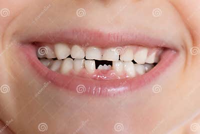 Milk Teeth and the First Molar Growing Stock Photo - Image of milk ...