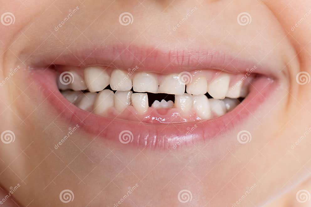 Milk Teeth and the First Molar Growing Stock Photo - Image of milk ...
