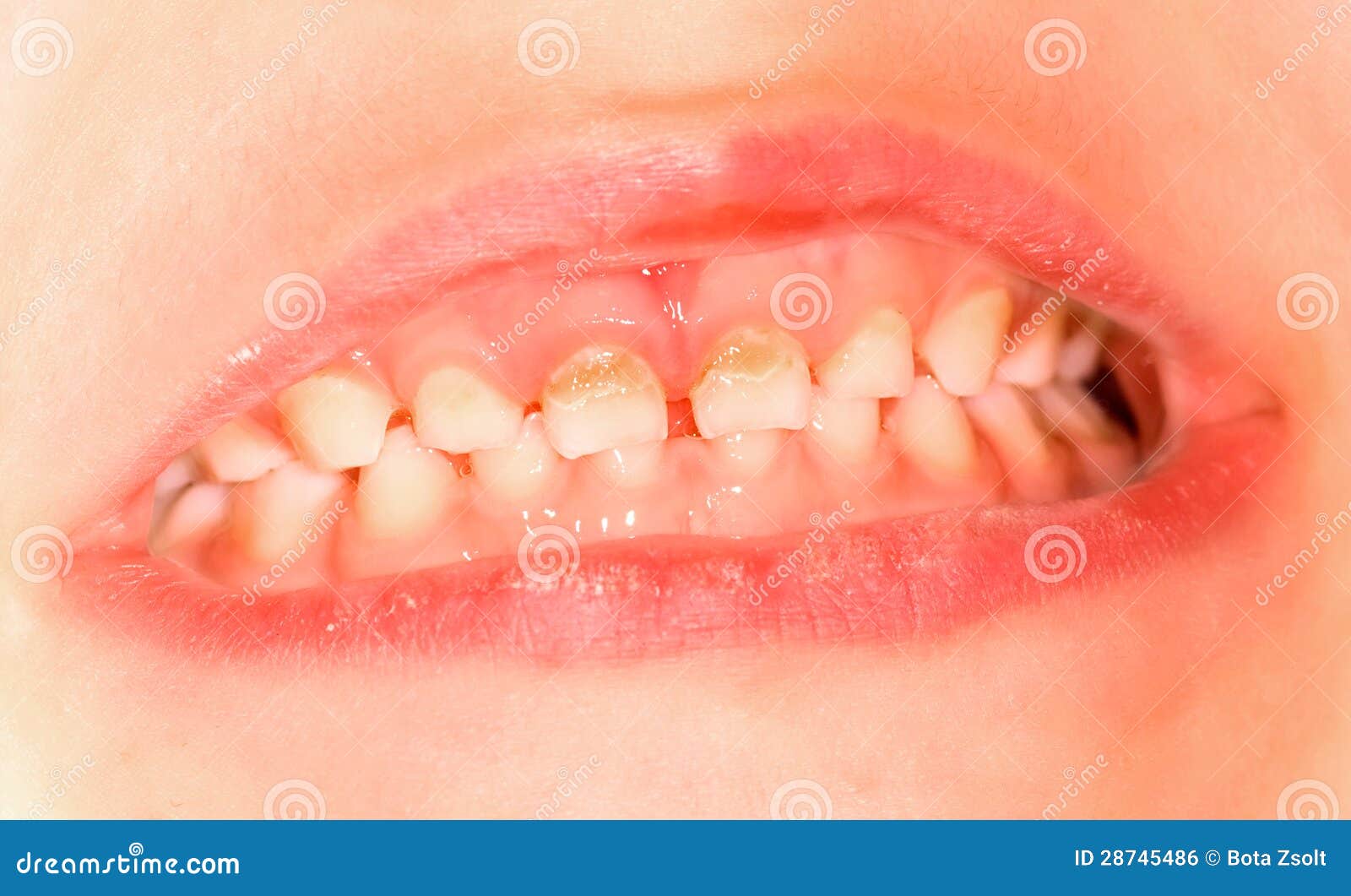 Milk tooth stock photo. Image of teeth, healthy, examine - 28745486