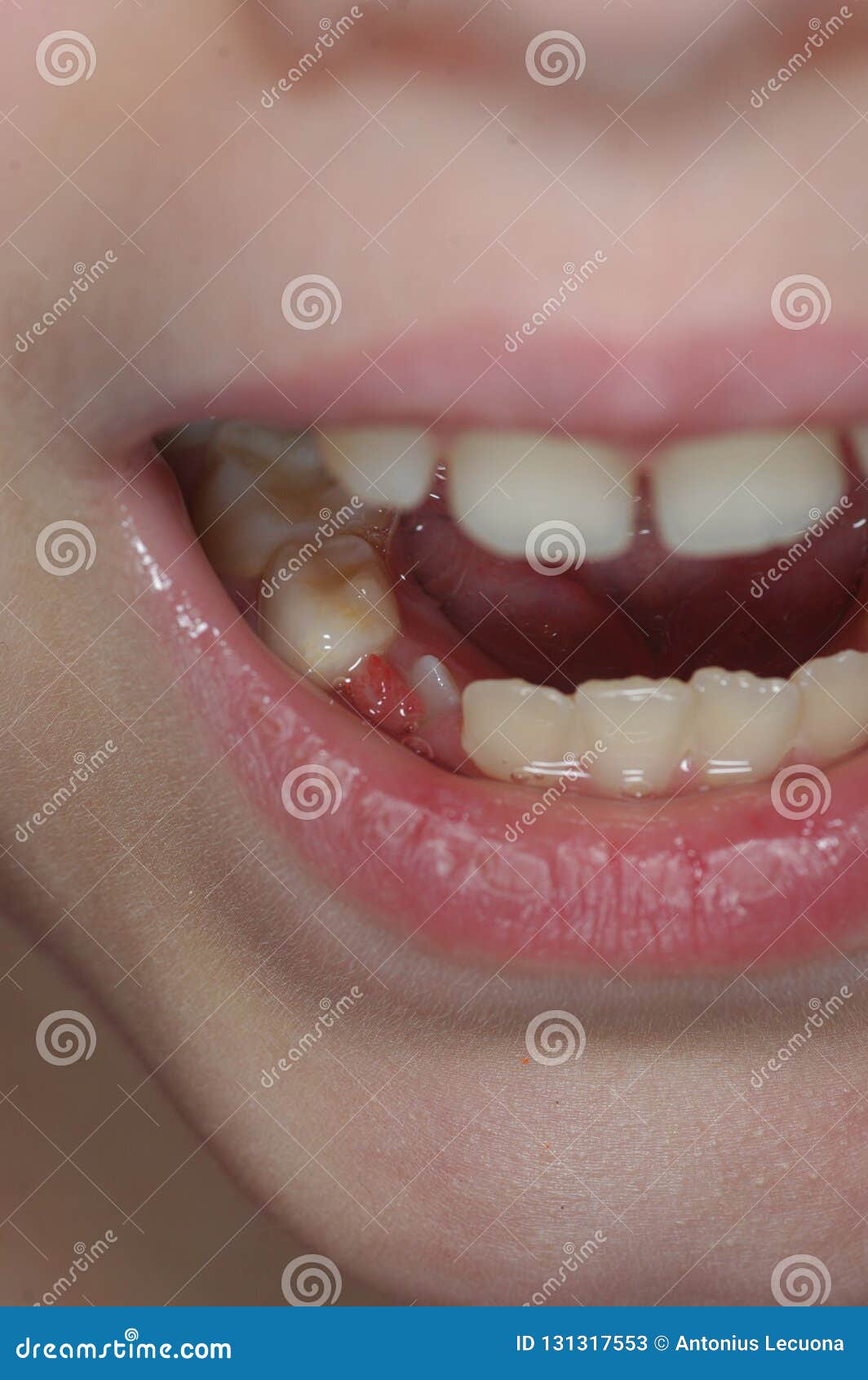 Milk tooth of a child stock image. Image of early, children - 131317553