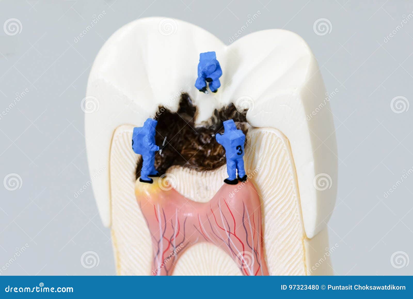 Miniature People Scientist at Work with Decayed Tooth Model Stock Photo ...
