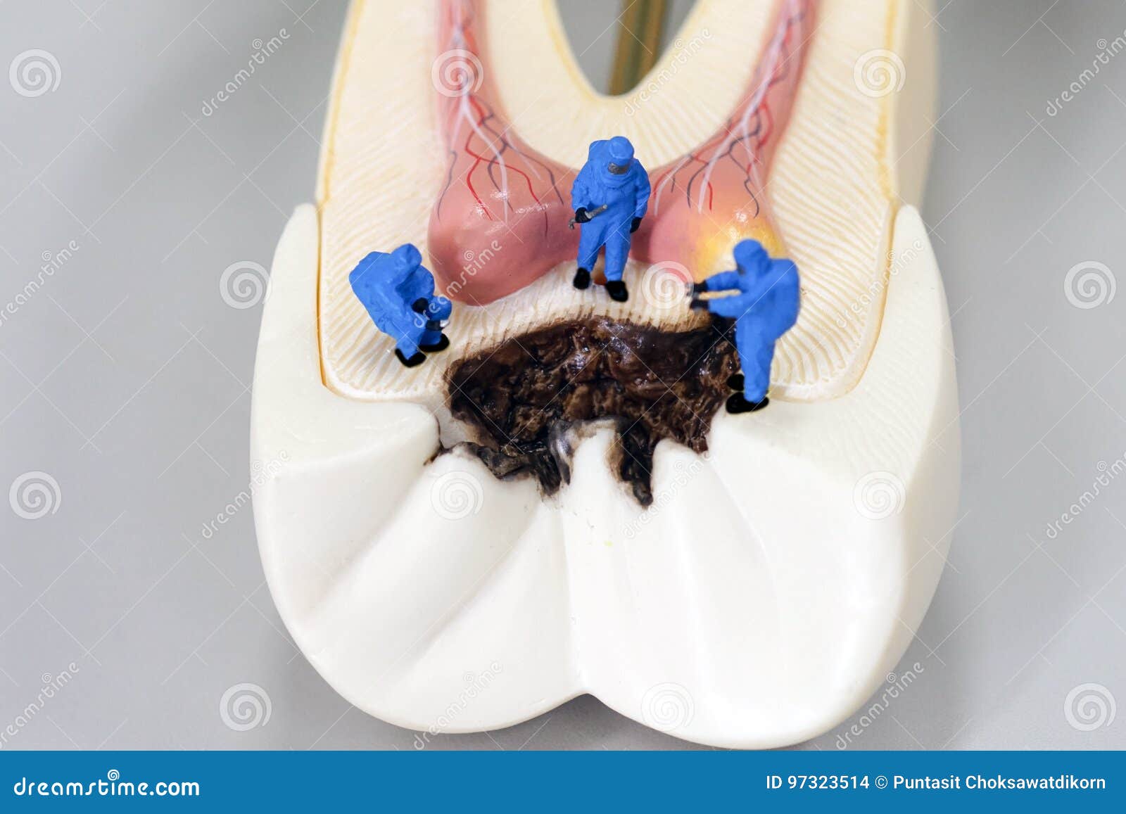 Miniature People Scientist at Work with Decayed Tooth Model Stock Photo ...