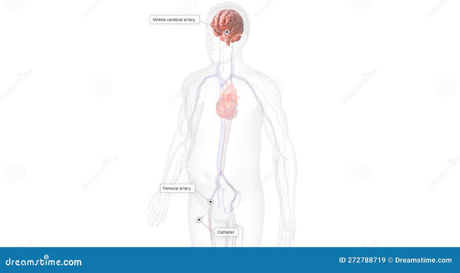 The Minimally Invasive Access for Embolectomy Stock Illustration ...