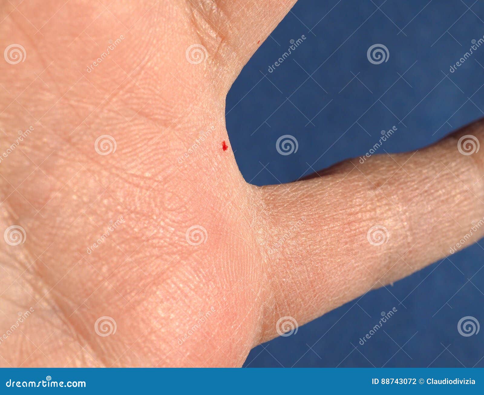 Minor bruise on hand stock photo. Image of hand, healthcare - 88743072
