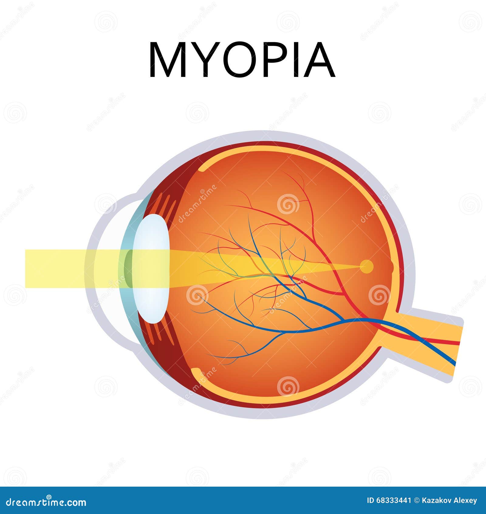 Miopia La Miopia Sta Essendo Miope Illustrazione Vettoriale ...