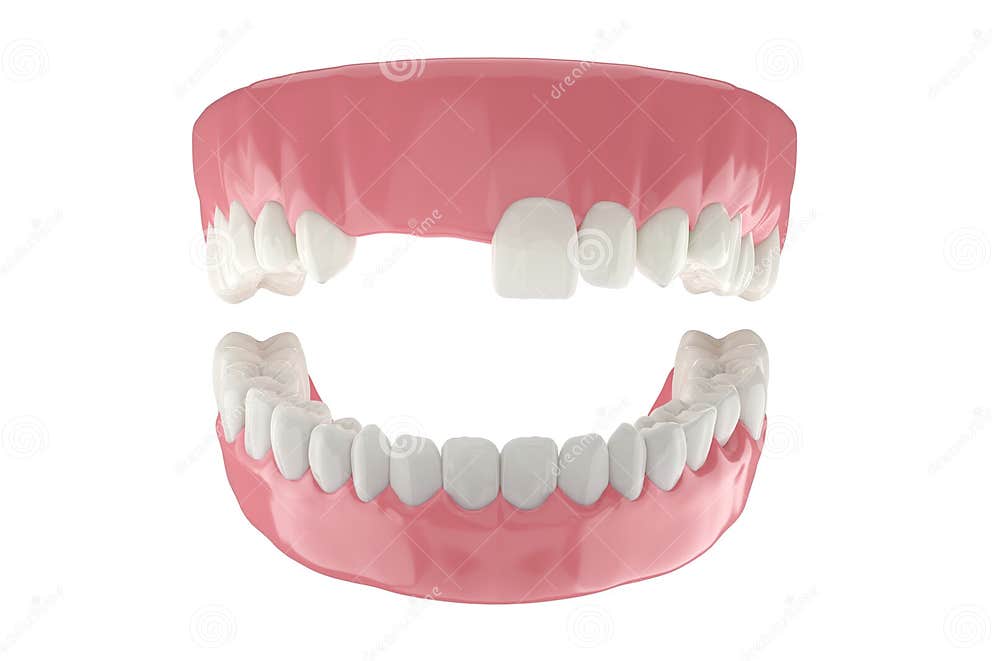 Missing Front Teeth with Full Tooth and Gums Stock Illustration ...