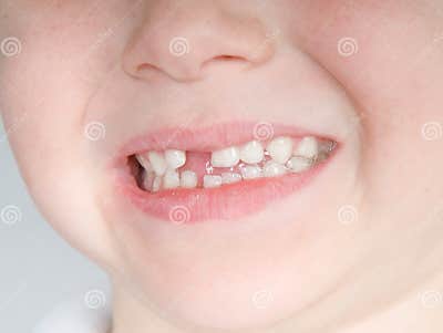 Missing front tooth stock photo. Image of cute, child - 13120346