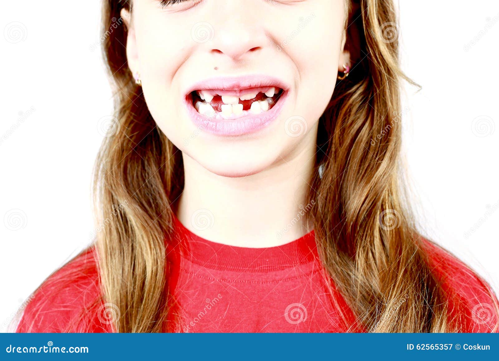 Missing Front Tooth stock image. Image of girl, close - 62565357