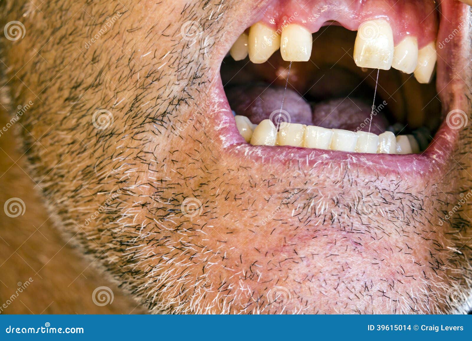 Missing Tooth stock photo. Image of mouth, tooth, root - 39615014