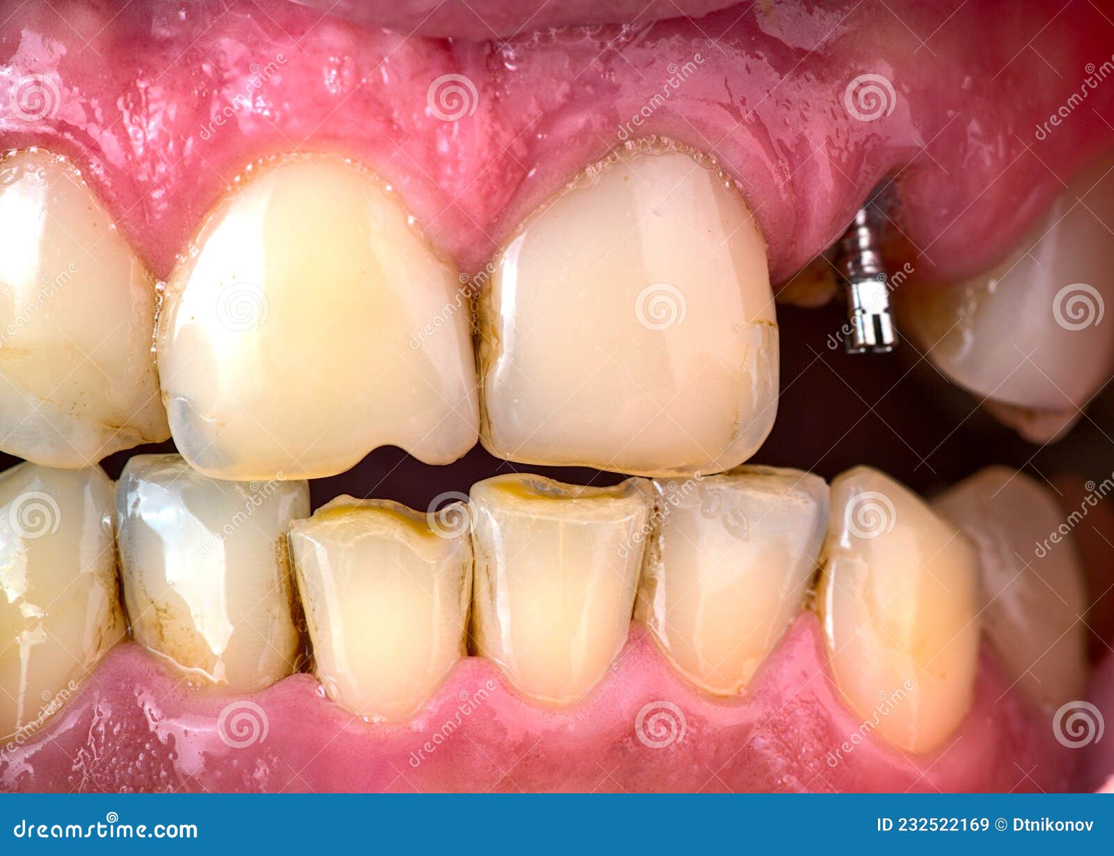A Missing Tooth and a Stent Screwed into Its Place in Closeup. Stock ...