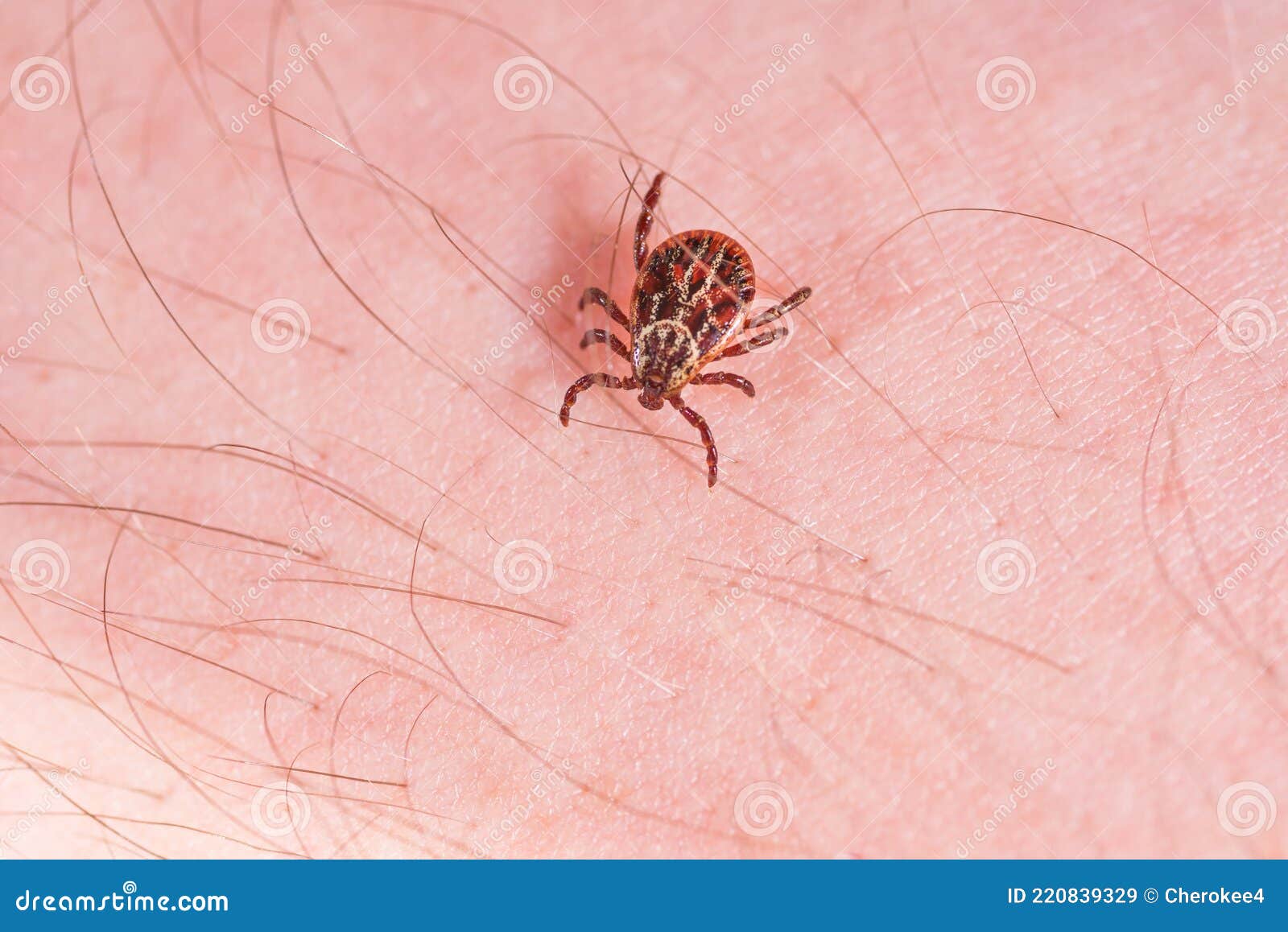 Mite on the Skin. Danger of Tick Bite. Stock Image - Image of tick ...