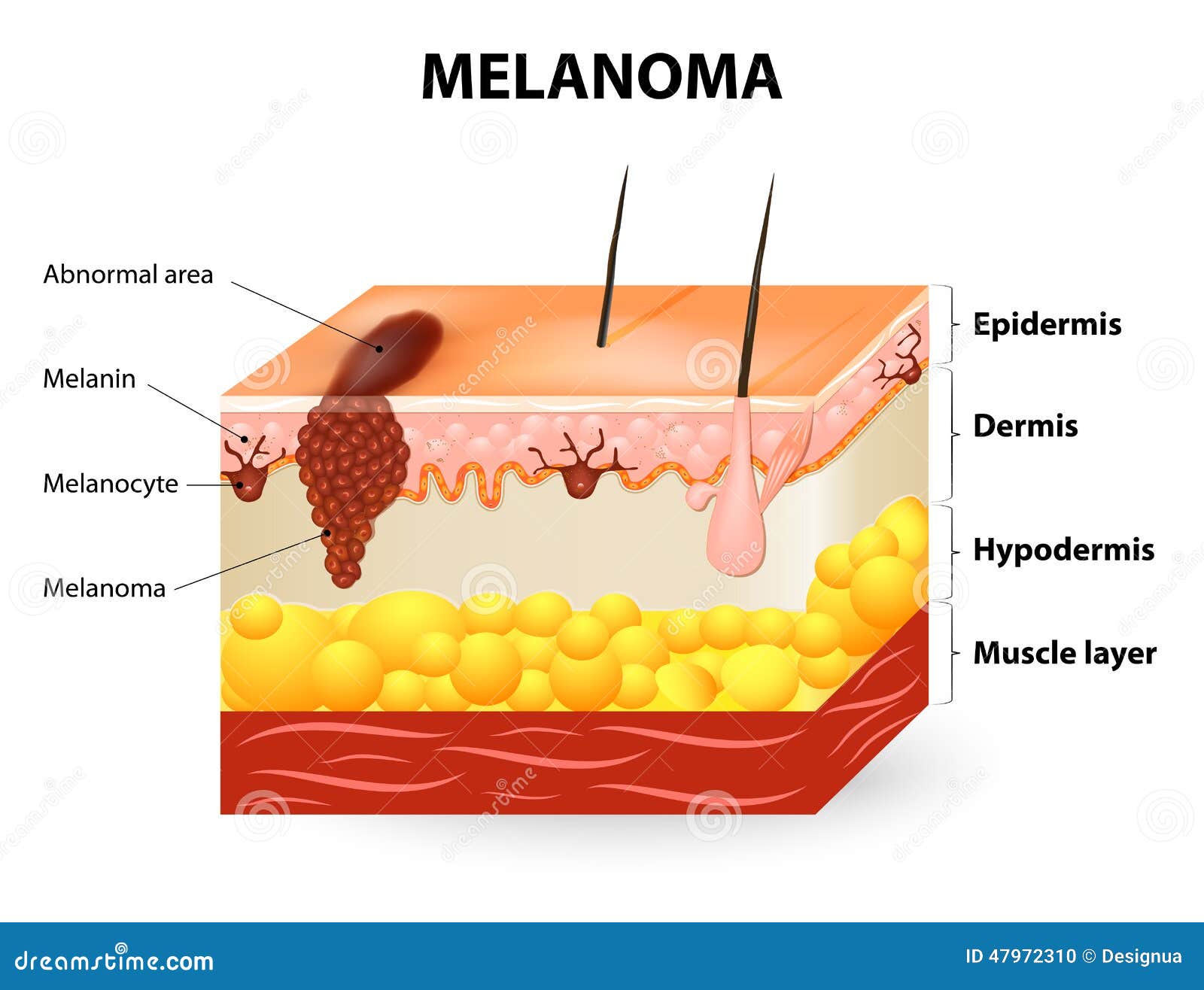 Mélanome Ou Cancer De La Peau Illustration De Vecteur Image 47972310
