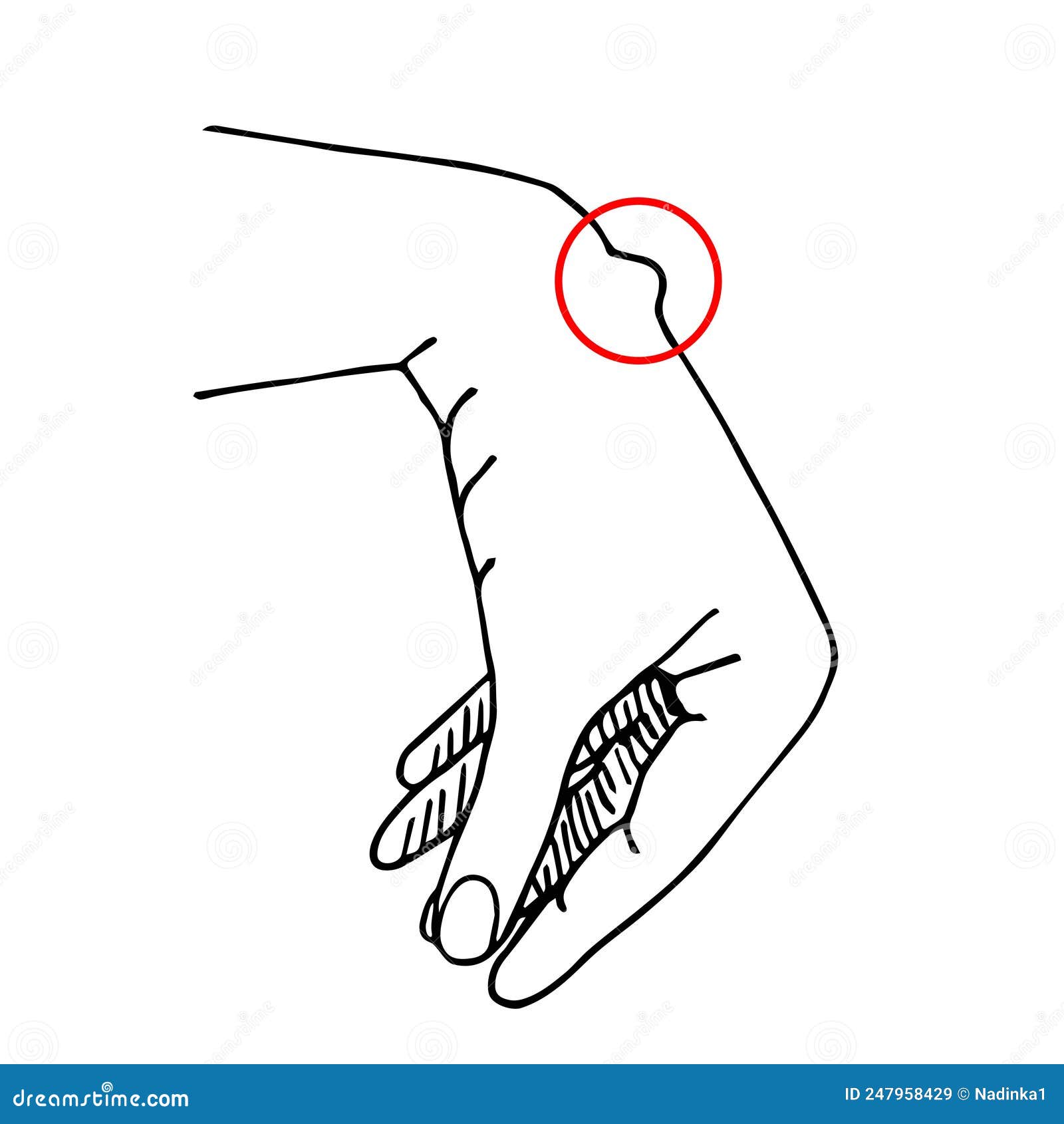 Simple Vector Black Outline Drawing. Hygroma on the Wrist Joint ...