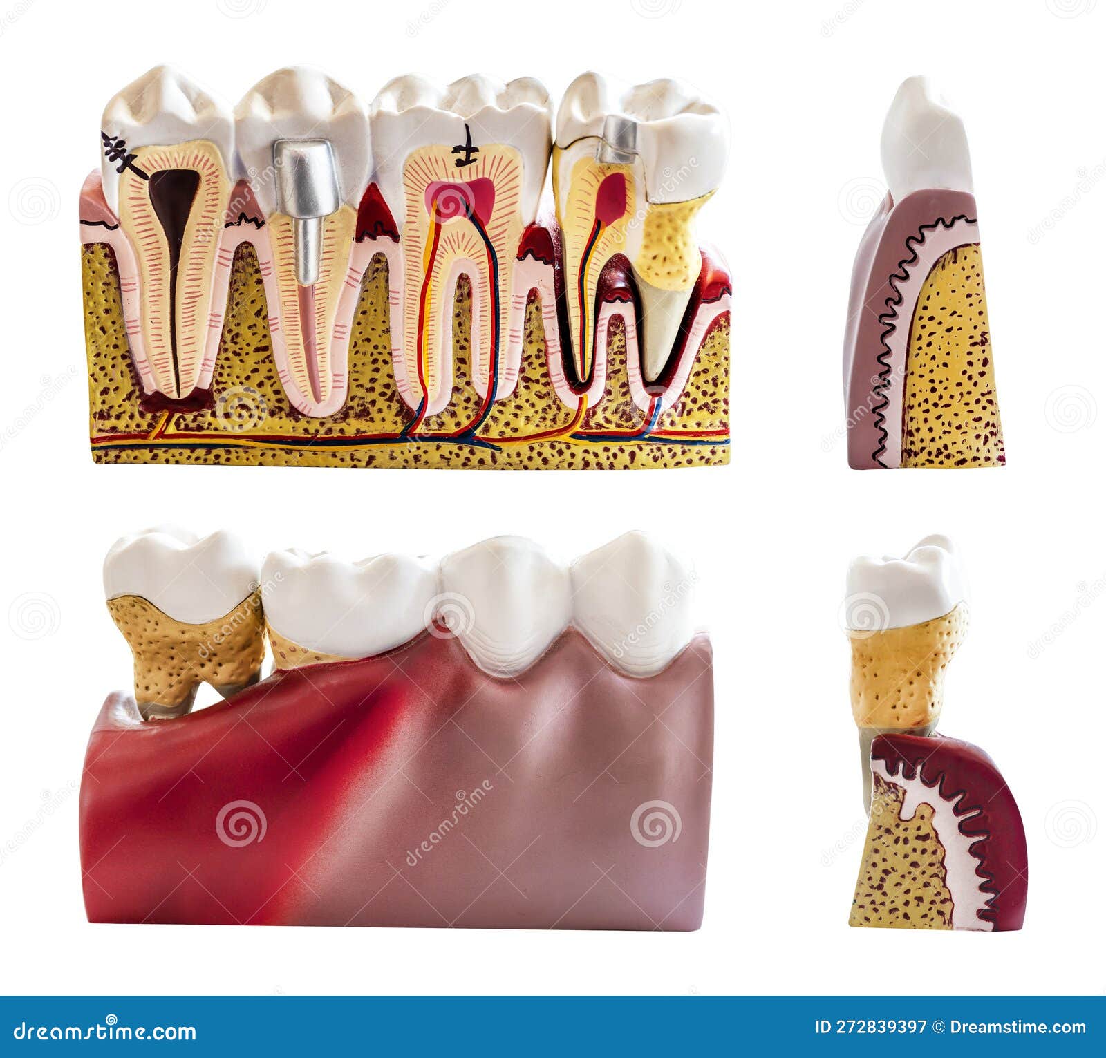 Mockup Example Teeth Treatment Isolated on White Background with ...