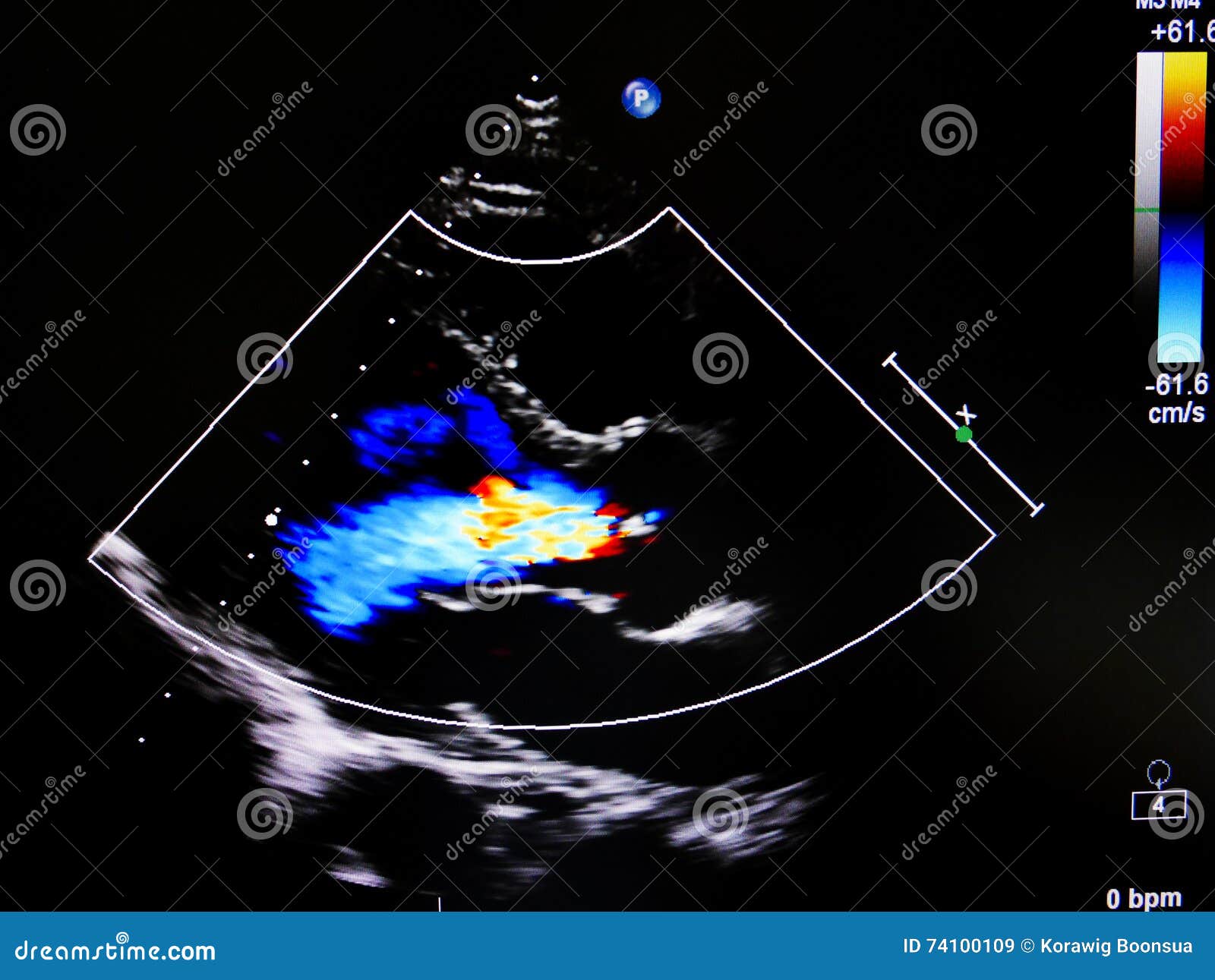 Mode De Couleur D'écoulement Dans L'échocardiogramme Image stock ...