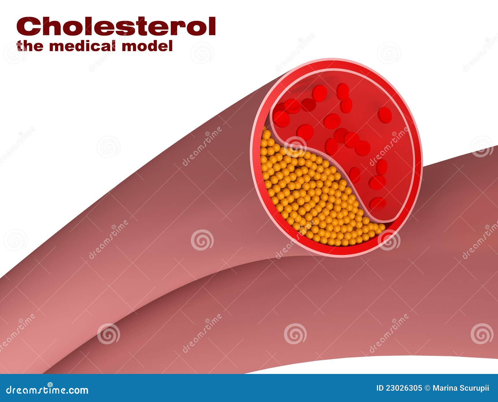 Model of Cholesterol in Artery Stock Illustration - Illustration of ...