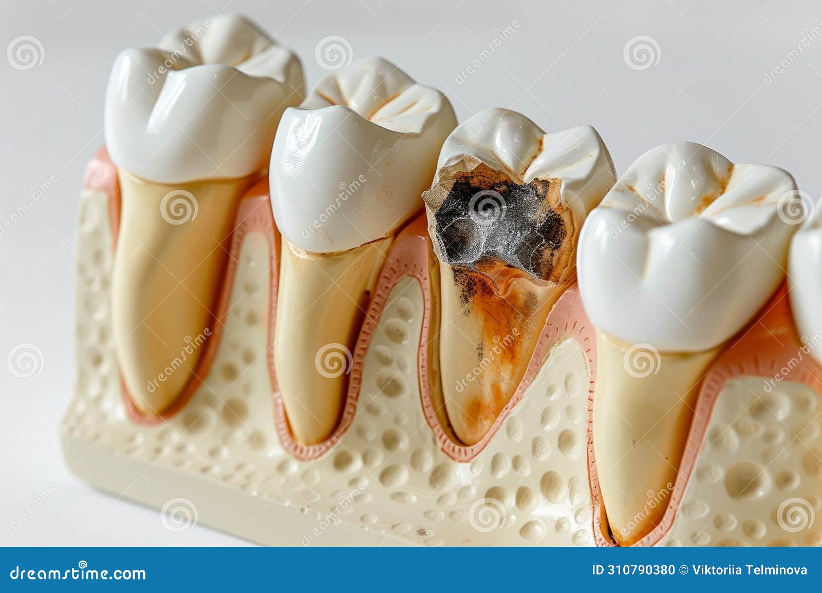 A Model of Healthy Teeth and Caries-affected Teeth on a White ...