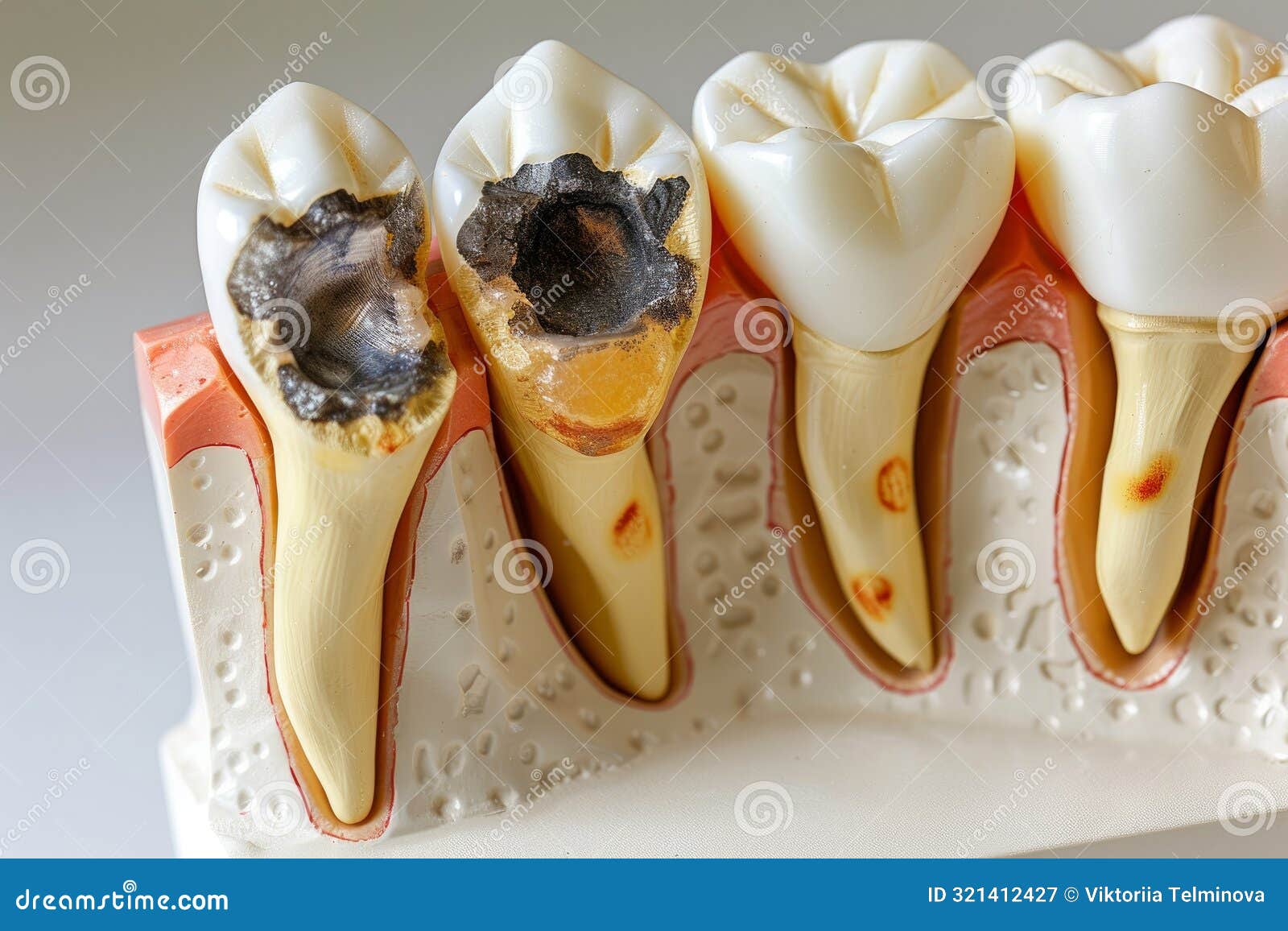 A Model of Healthy Teeth and Caries-affected Teeth on a White ...