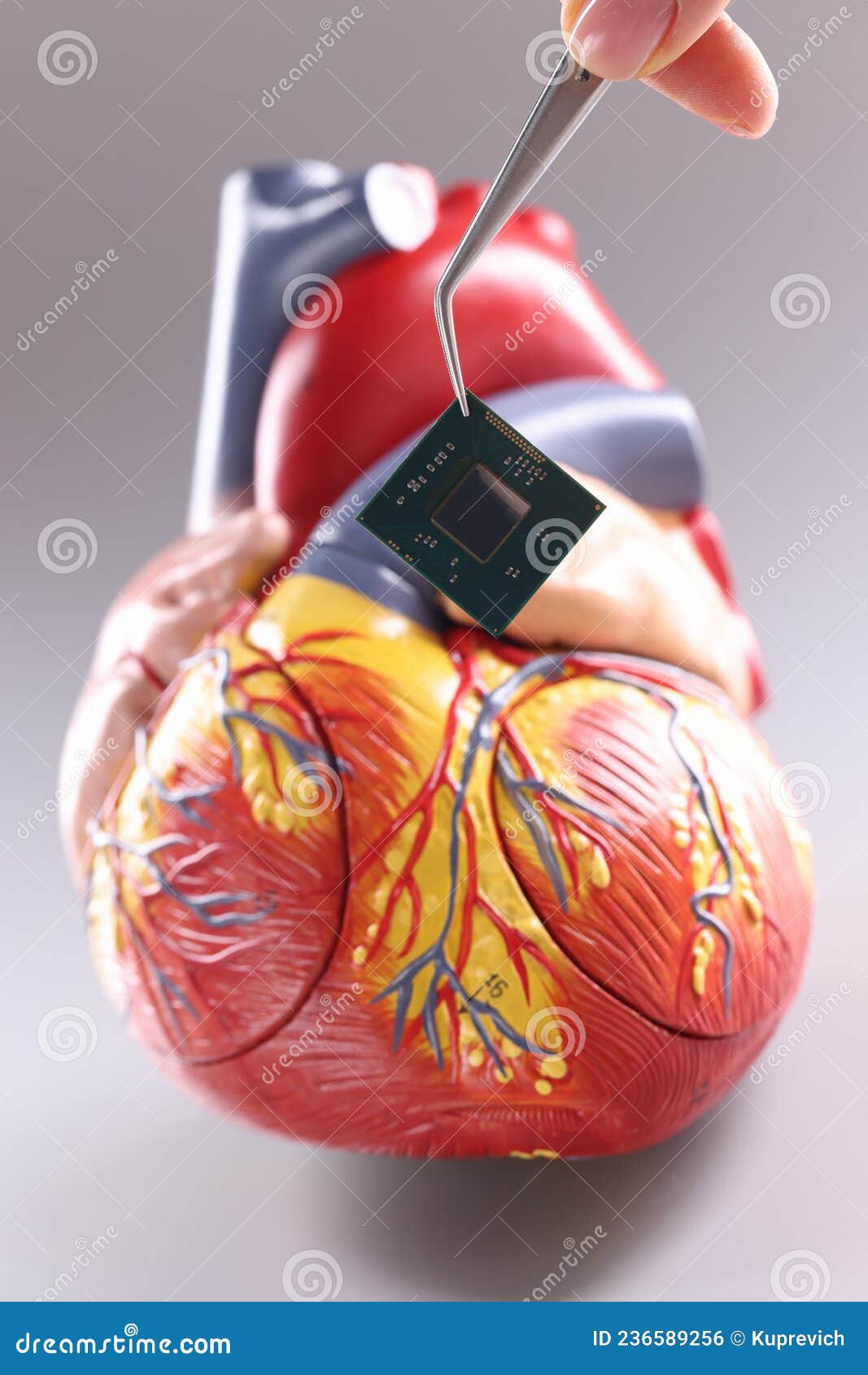 Model of Heart with Cardiac Pacemaker in Form of Chip Stock Photo ...