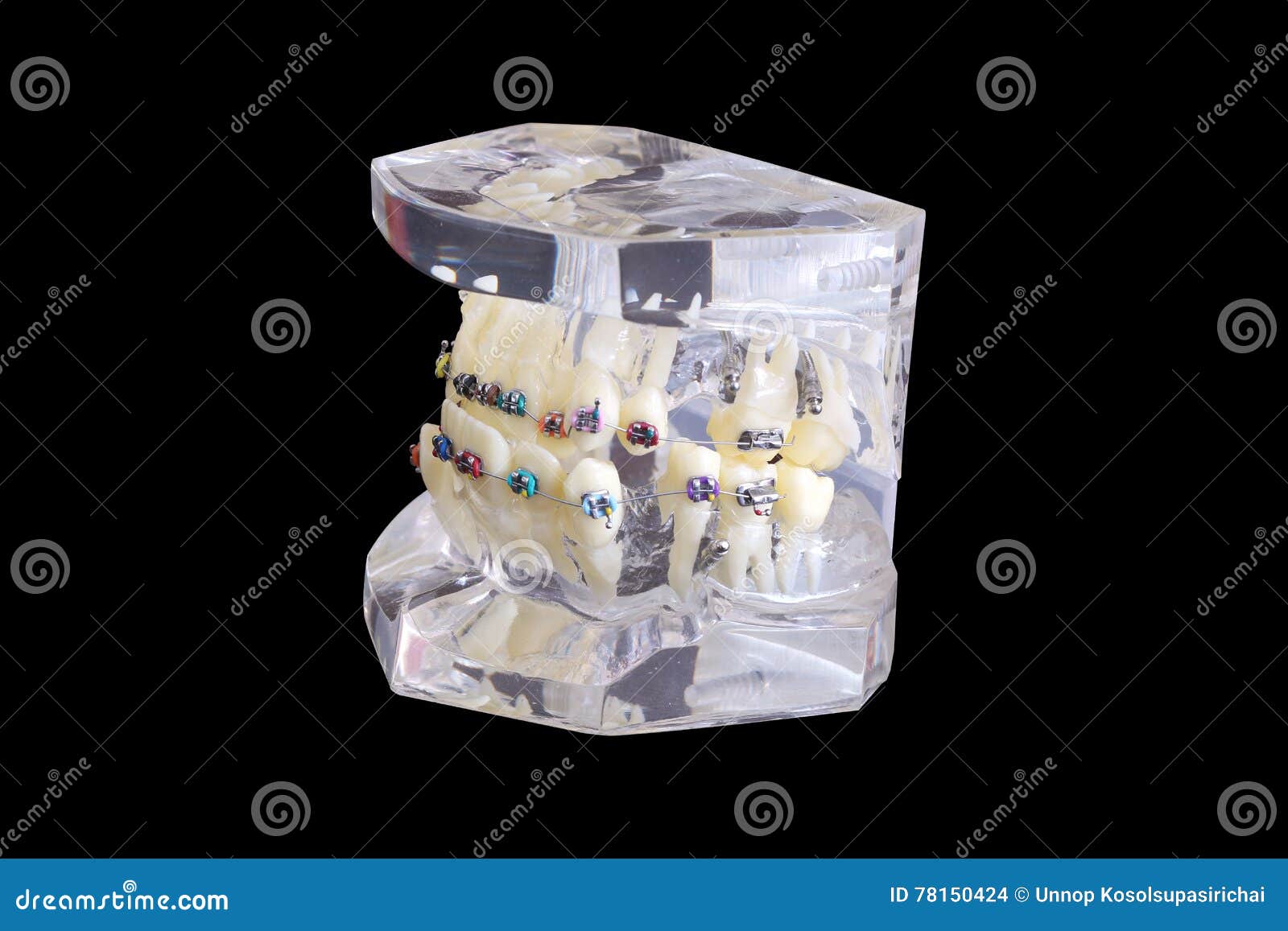 Model of Human Jaw with Wire Braces Attacheg Isolated on Black ...