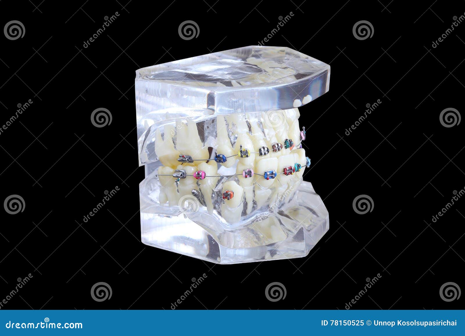 Model of Human Jaw with Wire Braces Attacheg Isolated on Black ...