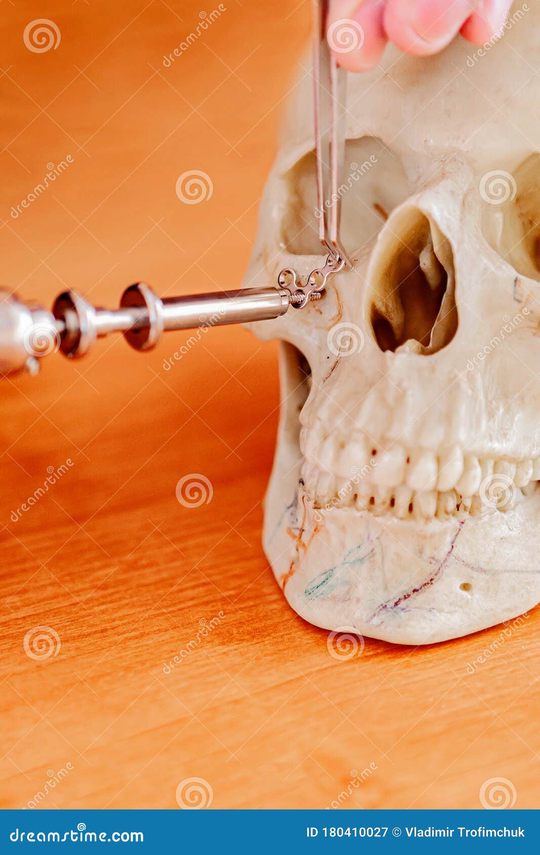 Model of a Human Skull with a Attach Prosthesis Attached To it for ...