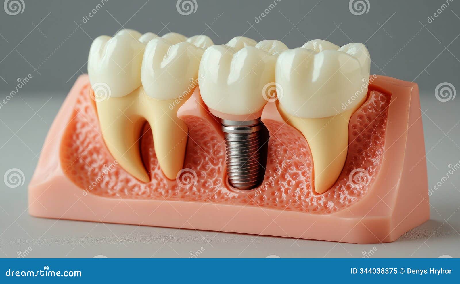This Model Illustrates the Components of Dental Implants, Showing How ...