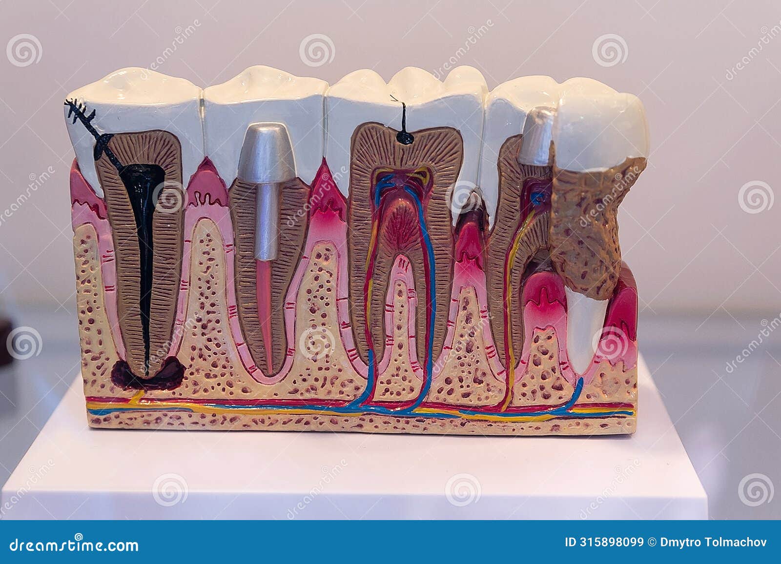Model with Samples of Treatment and Prosthetics of Human Teeth Stock ...