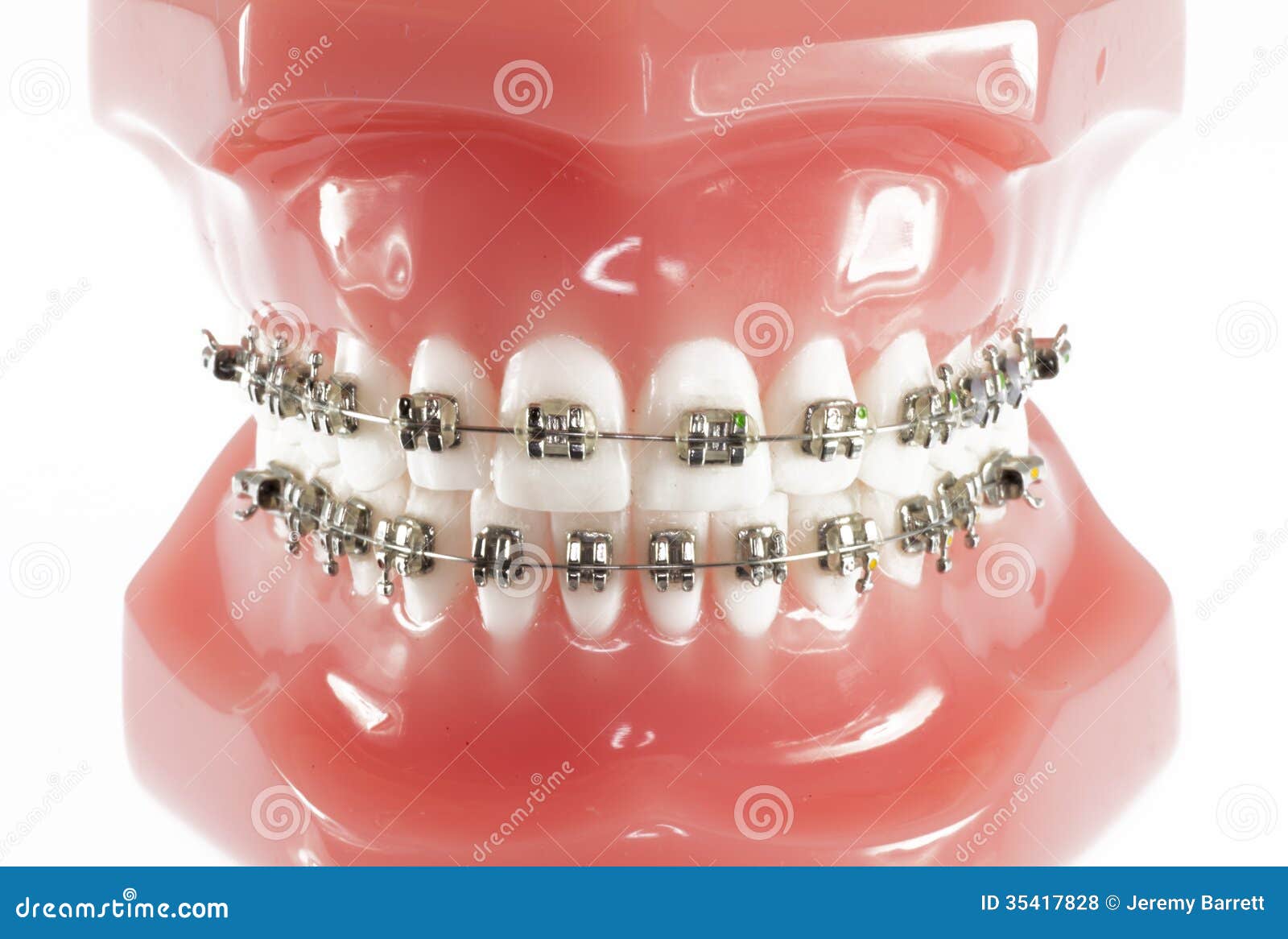 Model of Teeth with Braces stock photo. Image of tooth - 35417828
