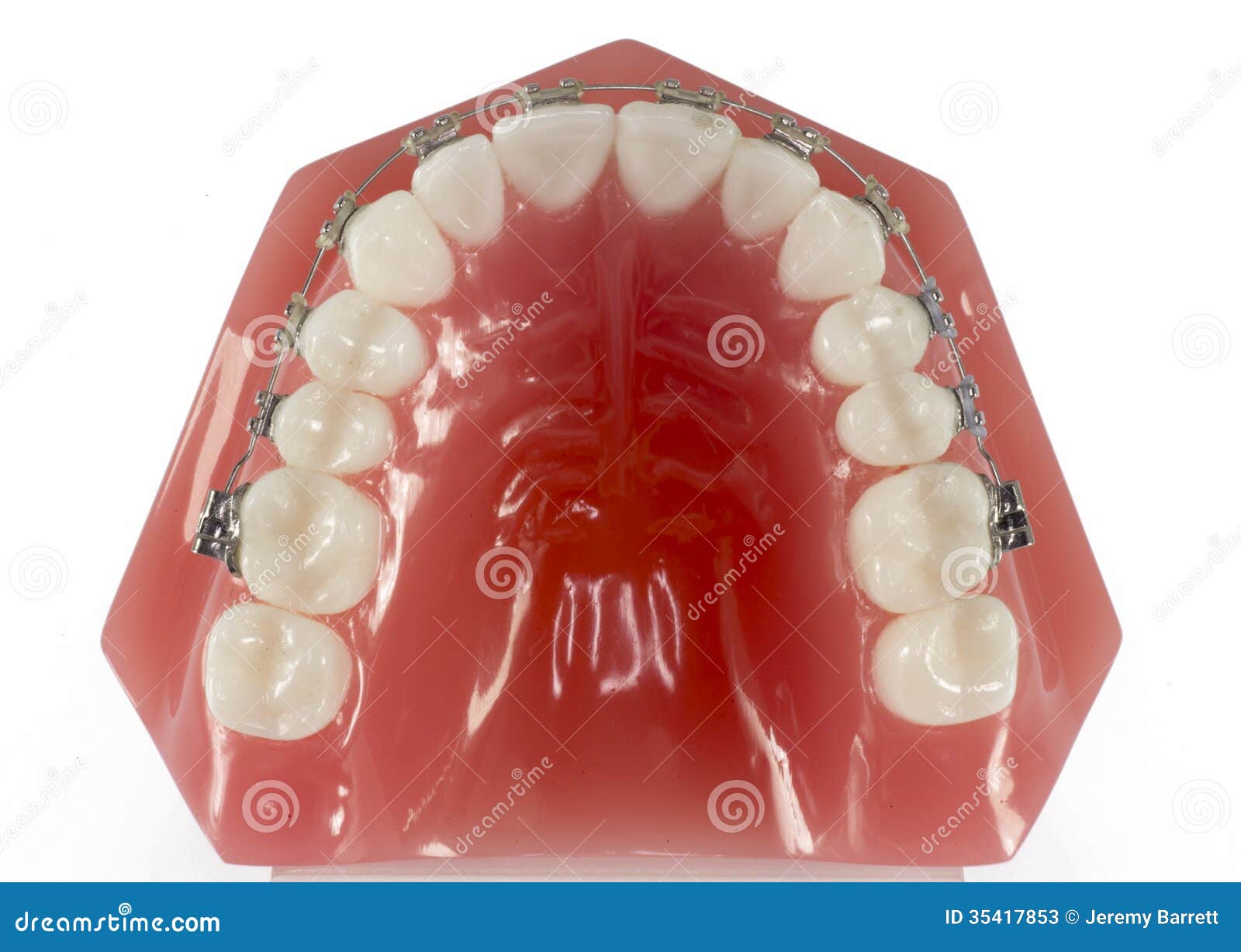 Model of Teeth with Braces Viewed from the Top Stock Image - Image of ...