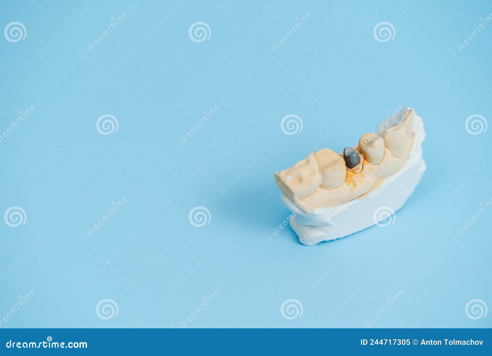 Model of Teeth and Gums. on Blue Background. Dental Concept Stock Image ...