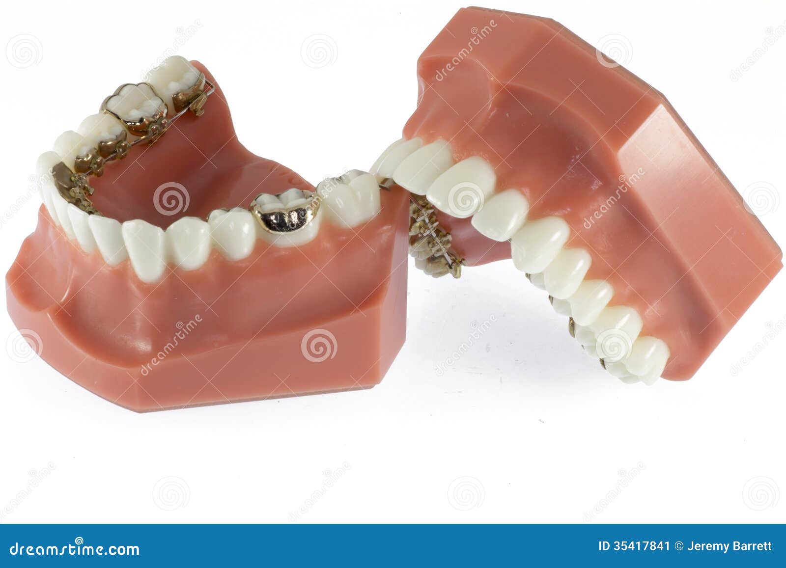 Model of Teeth with Lingual Braces Stock Image - Image of teeth ...
