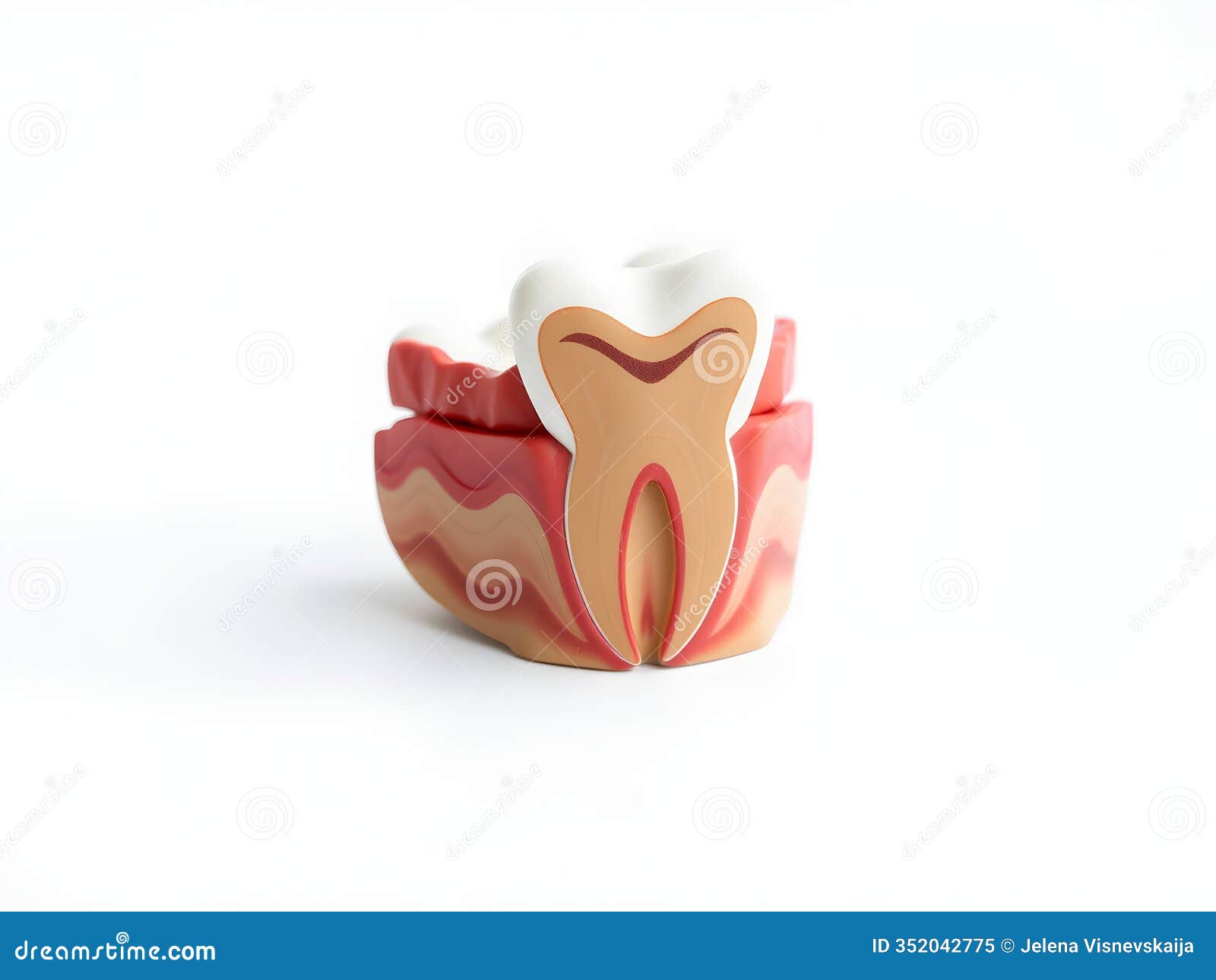 A Model of a Tooth with a Cavity and a Filling Stock Illustration ...