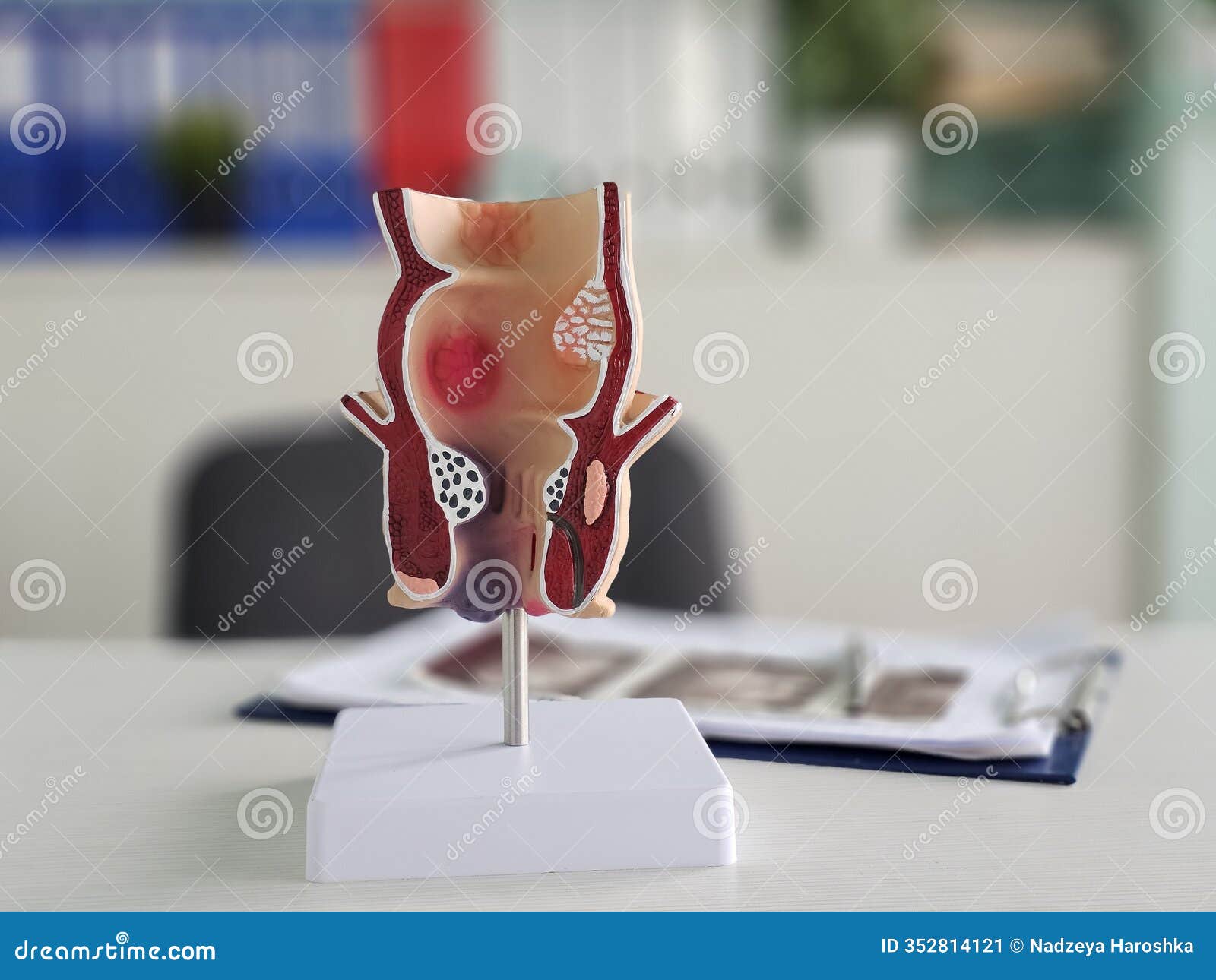 Model of Unhealthy Lower Rectum with Inflamed Vascular Structures ...