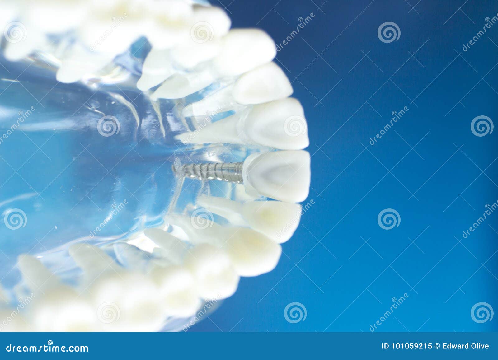 Modelo Dental De La Boca De Los Dientes Imagen de archivo - Imagen de ...