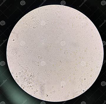 Moderate Bacteria in Urine Sample Stock Image - Image of cancer, dish ...