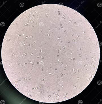 Moderate Bacteria in Urine Sample Stock Photo - Image of infection ...